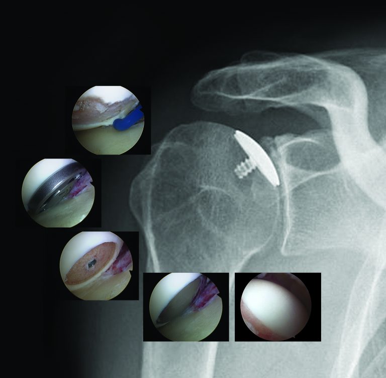 Orthopaedic pioneer, Dr. Steven Chudik, awarded patent for an ...