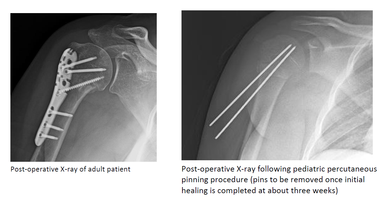 Humerus Humerus