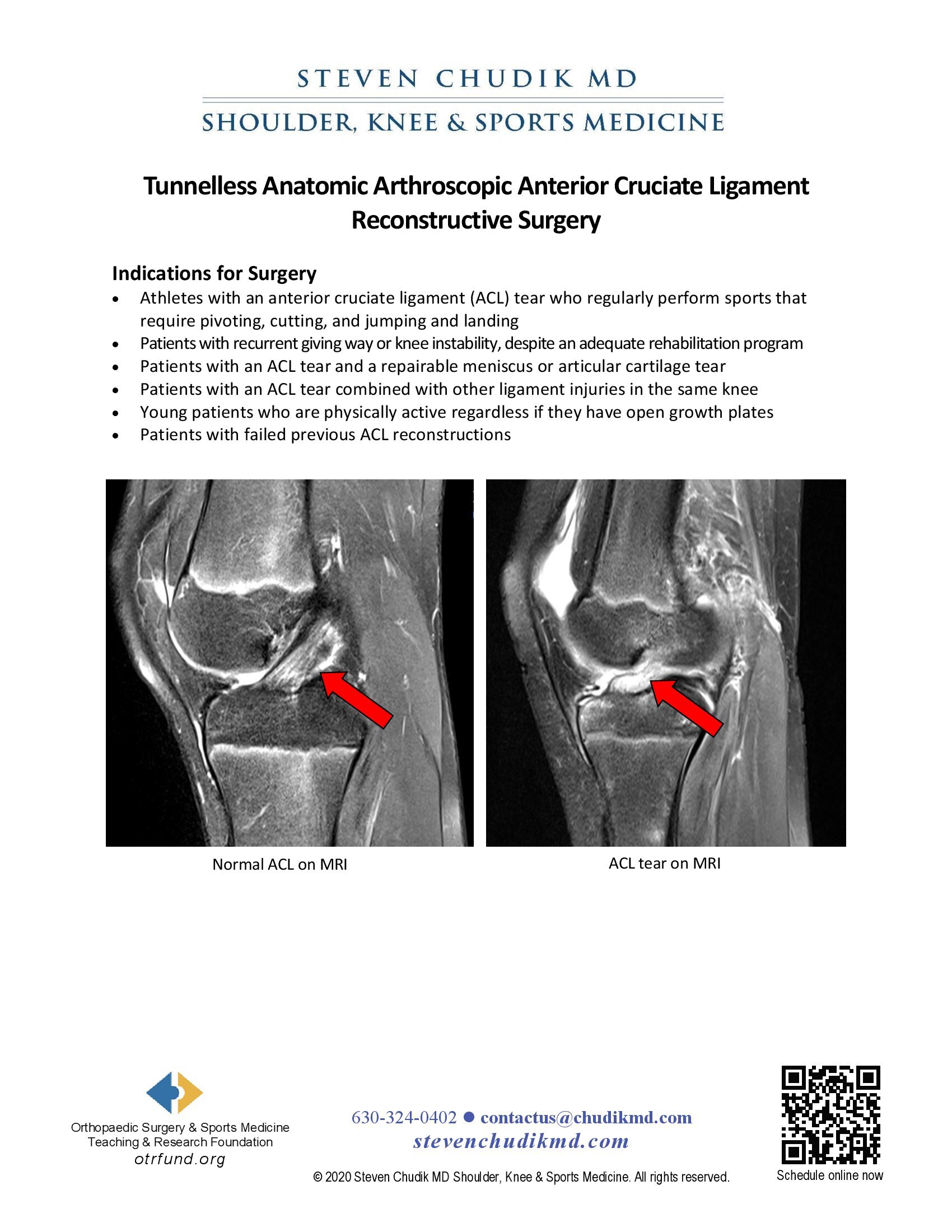 Arthroscopic Acl Reconstruction