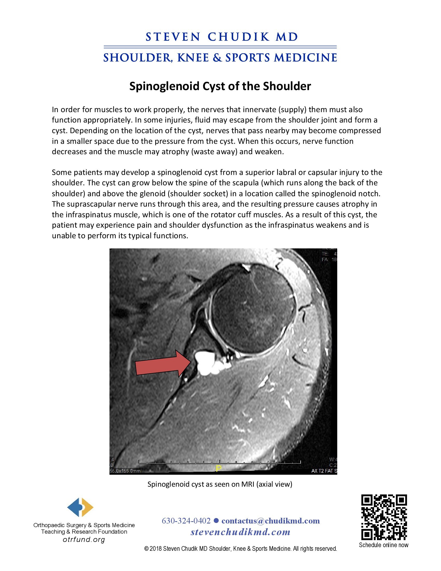 Spinoglenoid Cyst - Steven Chudik MD